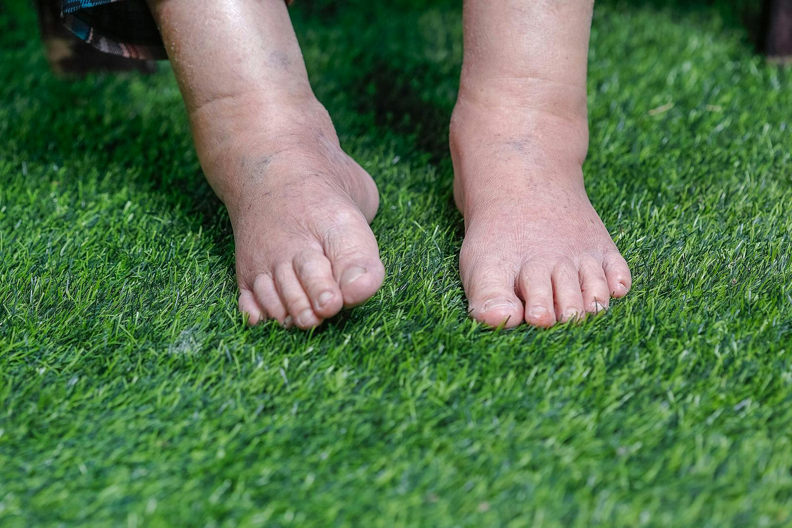 Swollen Ankles From Amlodipine And Swollen Tongue From Lisin The swollen-ankles-from-amlodipine-and-swollen-tongue-from-lisin-the