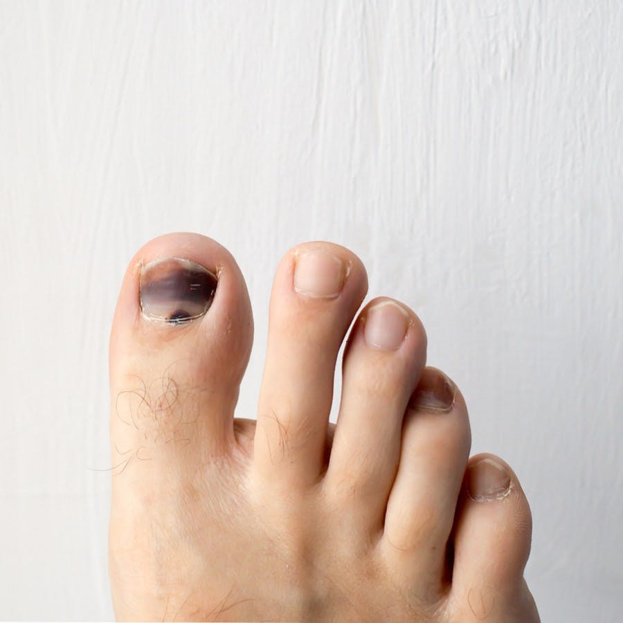 What Can You Do About a Black Nail? | The People's Pharmacy